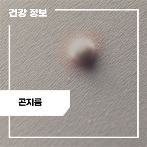 곤지름 초기증상 및 원인 자연치유 곤지름 성병 네이버 블로그
