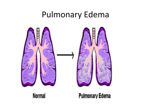 Atelectasis Collapse Ppt