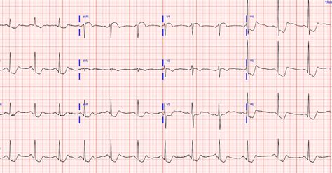 Dr Smiths Ecg Blog Omi Subendocardial Ischemia Does It Matter In This Clinical Context