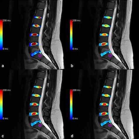 Color Coded T 2 Map Overlays Of A Multi Echo Spin Echo Mese B Download Scientific