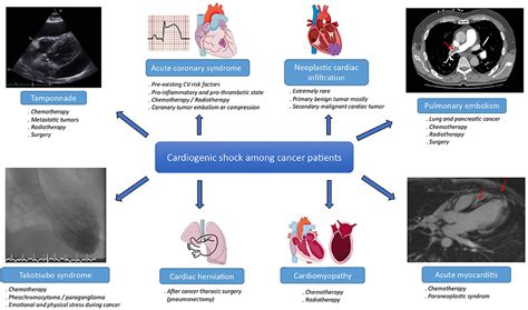 Cardiogenic Shock