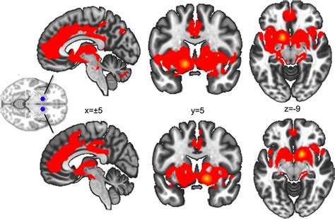 Whole Brain Functional Connectivity In Mbsr Patients Based On Left