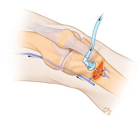Proximal Tibia Io
