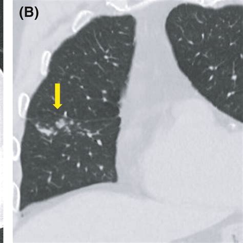 Computed Tomography Revealing Multiple Nodular Opacities In The Right