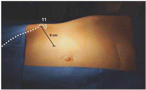 Open Partial Nephrectomy Abdominal Key