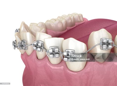 비정상적인 치아 위치 및 금속 중괄호 Tretament와 보정 의학적으로 정확한 치과 3d 일러스트레이션 치아교정기에 대한 스톡 사진 및 기타 이미지 Istock