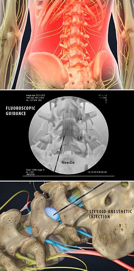 Lumbar Epidural Steroid Injection Santa Barbara Spine Surgeon Luis Obispo