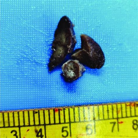 The Differences Between Intralobar And Extralobar Sequestration Download Scientific Diagram