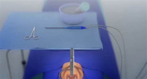 Cit And Total Tonsillectomy W Coblation Methods Of Tonsillectomy