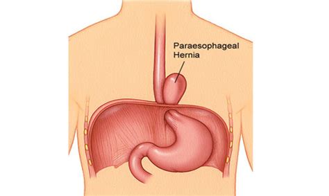 Repair Of Paraesophageal Hernia Dr Ashutosh Soni