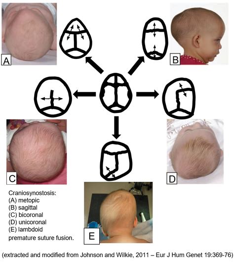 Craniosynostosis Moazen Lab