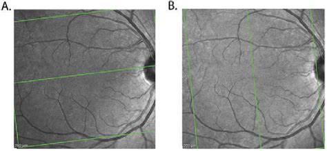 Spectralis Oct Horizontal A And Vertical B Macular Scan Acquisition Download Scientific