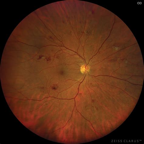 Male Sex Shorter Al Increase Diabetic Retinopathy Risk