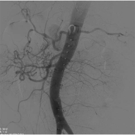 A B Sagittal Ct Angiogram 3d Reconstructions Showing Celiac Artery