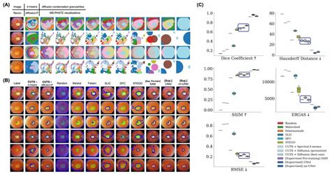 Segmenting Geographic Atrophy In Retinal Fundus Images A Download Scientific Diagram