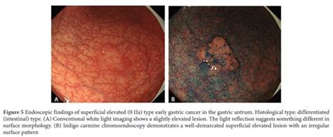 Endoscopy Gastric Lesions Paris Classification Early Gastric Cancer