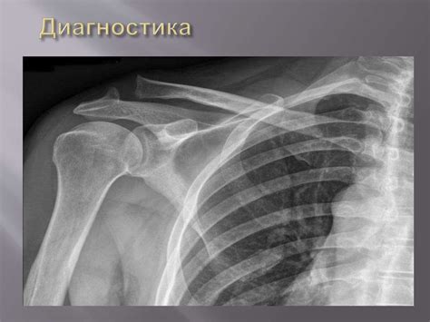 Разрыв акромиально ключичного сочленения презентация онлайн