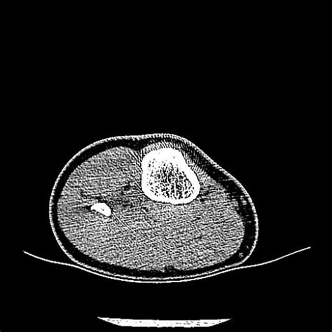 Tibia Recurvatum Lower Extremity Cts