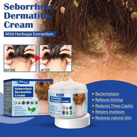 Seborrheic Dermatitis Scalp Treatment