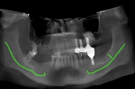Anatomical Overview Alveolar Ridge Preservation And Augmentation For