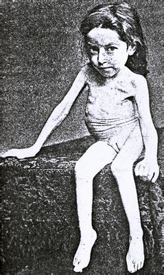 Hereditary Muscle Wasting Disease