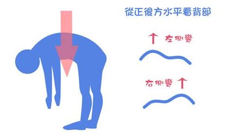 脊柱侧弯的简介和案例分析 知乎