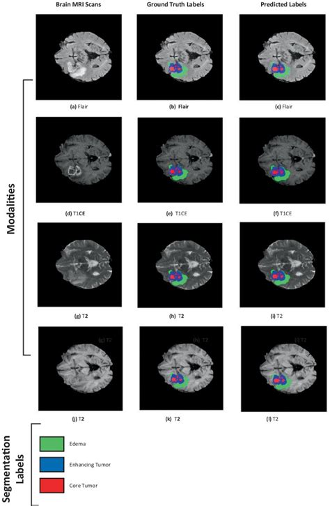 Multi Level Kronecker Convolutional Neural Network Ml Kcnn For Glioma