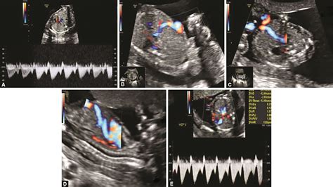 Ductus Venosus Ultrasound