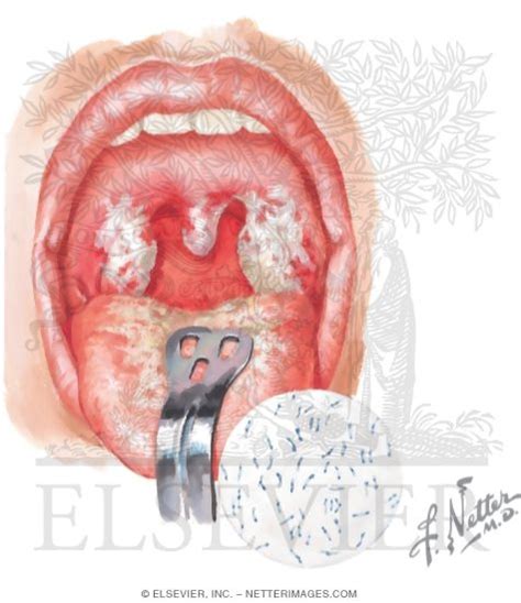 Pseudomembrane Diphtheria