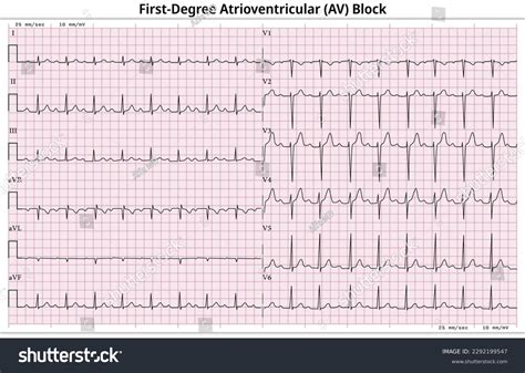Third Degree Heart Block