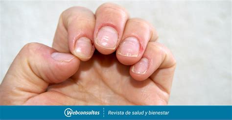 Problemas En Las Uñas De Las Manos Legiondragonfly