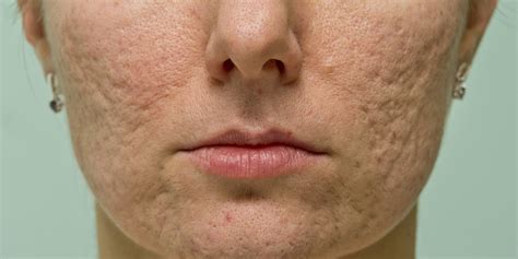 Acne Causes And Treatment Explained HuffPost UK