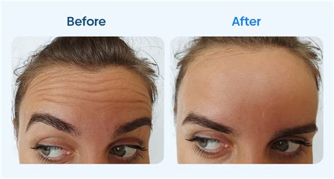 Daxxify Vs Botox Is The Newer Treatment Really Worth It