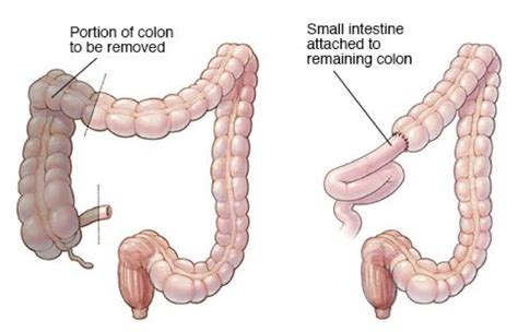Laparoscopic Right Hemicolectomy