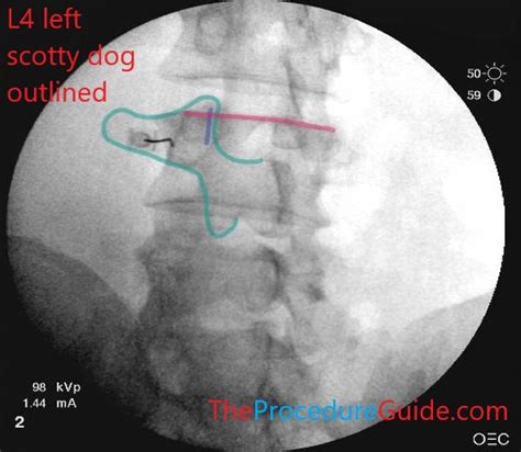 Fluoroscopic Guided Lumbar Medial Branch Block Lmbb Technique And Overview The Procedure Guide