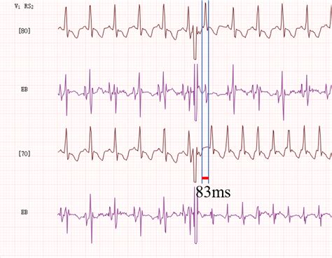 atrioventricular nodal reentrant tachycardia and atrial flutter combined exist simultaneously in