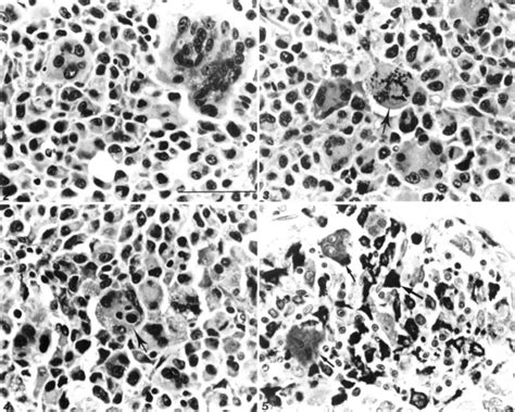 Abnormal Mitotic Figure With Multiple Mitotic Spindles Arrow He