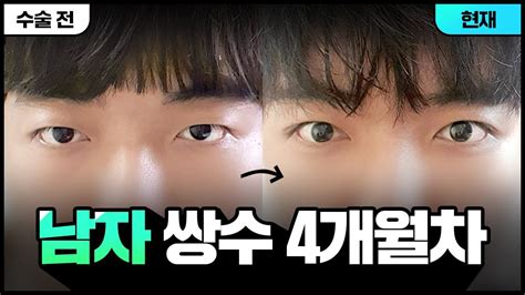 졸린눈에서 아이돌눈이 되기까지 │ 남자 쌍수 4개월차 후기 Youtube