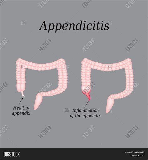 Appendicitis Vector And Photo Free Trial Bigstock