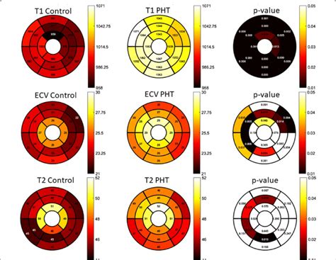 Segmental Distribution American Heart Assocaition Aha 16 Segment