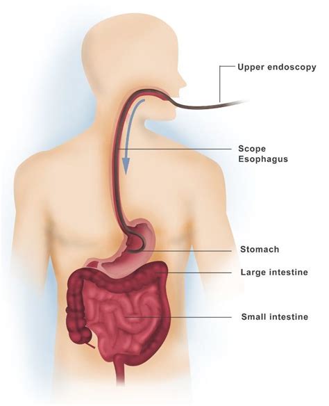 Endoscopy Of The Esophagus And Duodenum At Sean Chaffey Blog