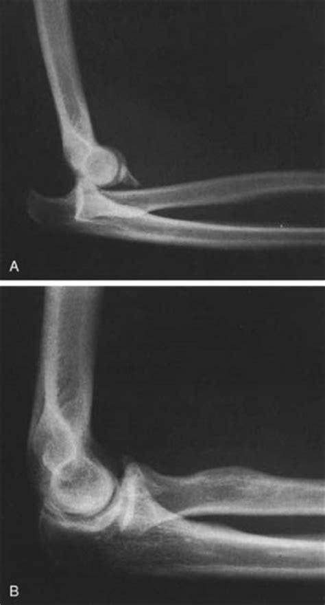 Elbow Dislocations Musculoskeletal Key