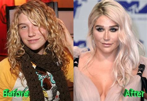 Kesha Plastic Surgery From Duckling To Swan Or Not