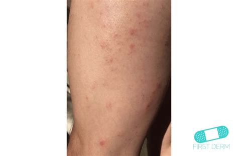 Scabies Online Dermatology