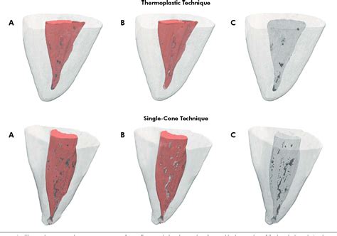 Figure 1 From Effect Of Obturation Technique Using A New Bioceramic Sealer On The Presence Of