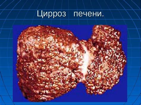Цирроз печени симптомы у женщин и первые признаки заболевания