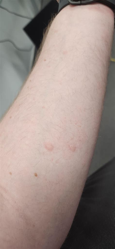 Fast Presenting Itchy Skin Bumps Rdiagnoseme
