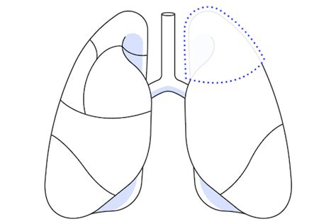 Da Vinci Surgery Lung Lobectomy Robotic Assisted