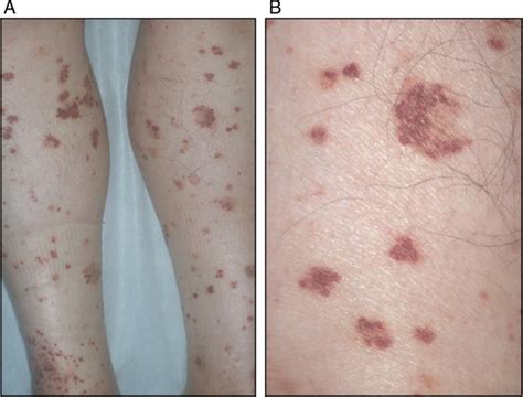 Purpura A Diffuse Small Palpable Purpura On The Lower Extremities Download Scientific