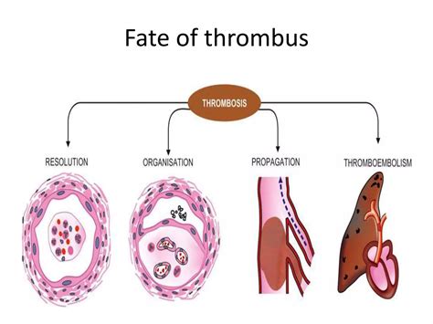 Hemodynamic Disorders Thromboembolic Disease And Shock Hypercoagulable